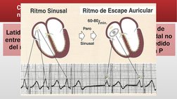 Características del Ritmo Nodal en ECG | PDF | Enfermedades ...