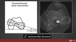 Protocolo de Lyon para Tomografia de Joelho | PDF