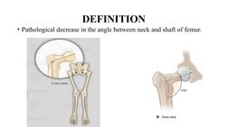 Understanding Coxa Vara and Valga | PDF | Hip | Skeletal System