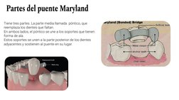 Puente Maryland: Proceso y Consideraciones | PDF | Anatomia dental ...