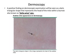Scabies Dermoscopy Sign