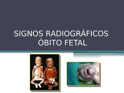 Signos radiográficos de óbito fetal | PDF