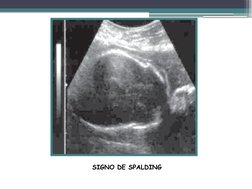 Signos radiográficos de óbito fetal | PDF