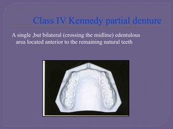 Class IV RPD Design Overview | PDF | Dentures | Mouth