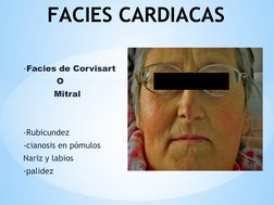 Facies Cardíacas y Cianosis en Patologías | PDF