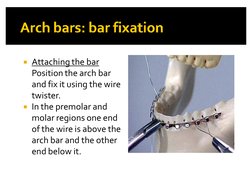 Arch Bar Applications in Oral Surgery | PDF | Tooth | Mouth