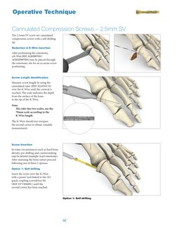 Stryker Fixos Screws Operative Guide | PDF | Screw | Implant (Medicine)