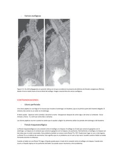 Procedimiento de Esofagograma con Bario | PDF | Estómago | Enfermedades ...