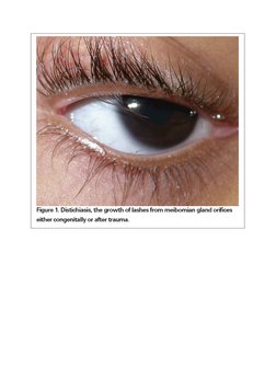 Eyelash Epilation and Cutting Procedures | PDF | Surgery | Ophthalmology