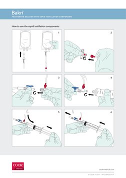 Bakri: Tamponade Technique For Postpartum Hemorrhage | PDF | Vagina ...