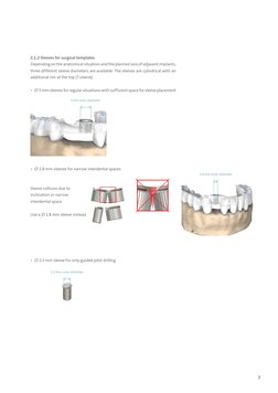 Straumann® Guided Surgery | PDF | Dental Implant | Surgery