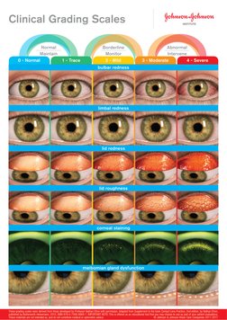 Efron Grading Scale for Eye Assessments | PDF | Cornea | Contact Lens