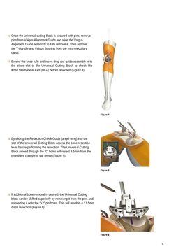 TKR Smith&nephew Technique Orthomatch GENESIS II Surgical Technique.10. ...